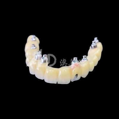 China Porcelain-Fused-to-Metal (PFM) Screw-Retained Implant Bridge for sale