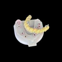 China Porcelain-Fused-to-Metal (PFM) Screw-Retained Implant Bridge for sale