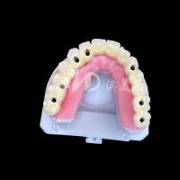 China Porcelain-Fused-to-Metal (PFM) Screw-Retained Implant Bridge for sale