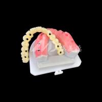 China Porcelain-Fused-to-Metal (PFM) Screw-Retained Implant Bridge for sale