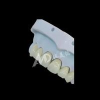China Full Contour Monolithic Zirconia Dental Crown for sale