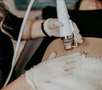 China Face Lift RF Microneedling Machine 10-200W For Females Acne Pigmentation for sale