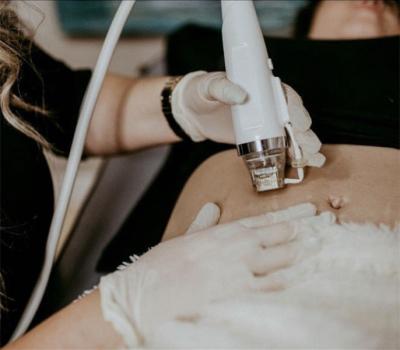 China Face Lift RF Microneedling Machine 10-200W For Females Acne Pigmentation for sale