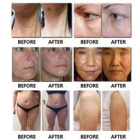 China 20000 Shots Painless Smas HIFU Beauty Machine , Portable Face Wrinkle Remover for sale
