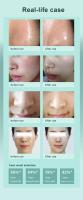 China Dermabrasion 65Khz Oxygen Hydrafacial Machine Bubble Deep Cleaning for sale