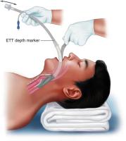 China Medical PVC Silicone Laryngeal Mask Airway with CE and ISO Approved for sale