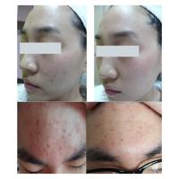 China 26W 60Hz Plasma Pen Acne Scars For Eyelids Face Liting Anti Wrinkle Aging for sale