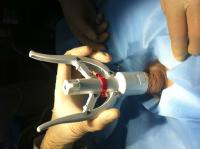 China Durable Disposable Circumcision Stapler , Multipurpose Adult Circumcision Device for sale