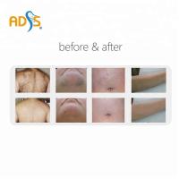 China Manufacture ADSS ND YAG  1064nm Long Pulse Laser Hair Removal Laser Device for sale