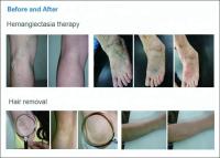 China ADSS Laser Long Pulse Nd Yag Laser  Big Spot Size 1064nm Vascular Laser Hair Removal Machine for sale