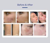 China 2025 New Big Power Ipl Laser Hair Removal Device and Ipl Hair Removal Machine for Hair Removal Skin Rejuvenation Diodenlaser for sale
