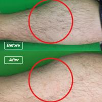China Laser Hair Removal Machine with 755nm Alexandrite and 1064nm Long Pulse Nd Yag Laser for sale