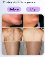China 755nm Alexandrite Laser 1064nm Long Pulse Nd Yag Laser Hair Removal Stationary Candle for sale