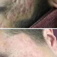 China Secret Portable Radiofrequency Facial Skin Tightening RF Fractional Microneedle RF Microneedling For Acne Scar Removal for sale