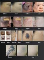 China Q Switched Tatoo Remover And Carbon Peel Equipment Nd Yag Laser Qswitch Tattoo Removal Machine for sale