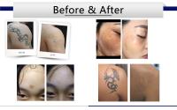 China Nd Yag Pico Laser Tattoo Removal , Laser Resurfacing Machines 1064nm for sale