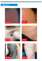 China Laser Beauty Equipment Home Use Nd Yag Laser 532nm 1064nm 1320nm Tattoo Removal Machine for sale