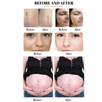 China Scar Removal Beauty Equipment Portable Fractional Co2 Laser Vaginal Tightening Machine Wrinkle Remover Device for sale