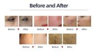 China Surfacing Fractional CO2 Laser System Surgical Beauty Equipment for Stretch Mark Removal for sale