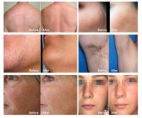 China Professional Vertical High Power Painless 808nm Diode Laser Hair Removal Machine Ice Platinum Device for sale