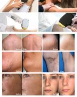 China Professional Painless Lazer 808 nm Titanium Beauty Device Diode Laser Hair Removal Machine for sale