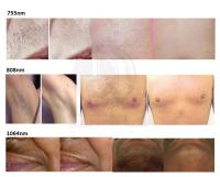 China DPL laser beauty Equipment diode laser epilation laser 755nm/808nm/1064nm laser ipl hair removal machines for sale