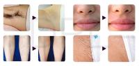 China 2022 New high power fixed 810nm diode to high quality laser rapid hair removal machine for sale