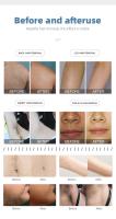 China Tattoo Eyebrow Pigment Removal 808nm diode laser Fast Hair Removal Multifunctional Beauty Equipment Machine for sale