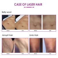 China Portable 808 808nm Diode 3 Wavelength Laser Permanent Hair Removal Depilation Skin Rejuvenation Cooling Technology Machine for sale
