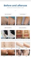 China Painless 808NM diode Laser Hair Removal picosecond laserTattoo Removal Machine For dark skin for sale