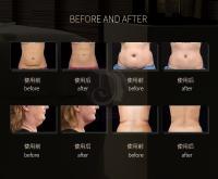 China Liposlim Ultrasound Vacuum Ultrasonic 80K RF Wrinkle Removal and Body Slimming Cavitation Machine for sale