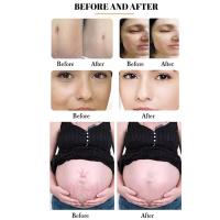 China BV13 Portable Co2 Fractional Laser 60W Co2 Fraccionado Laser Vaginal Tightening Co2 Laser Machine For Skin for sale