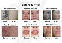 China Skin Rejuvenation Pico Laser Picosend Tattoo Removal Machine Carbon Peel Beauty Device for sale