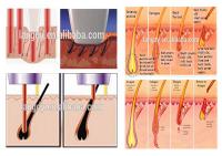 China 2000w 950nm Permanent IPL Hair Removal Machine for sale