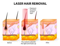 China Spa Salon 20HZ 808 Diode Laser Hair Removal Machine for sale