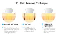 China 2000w OPT IPL+ 808NM DIODE LASER Technology For Hair Removal Equipment for sale