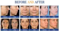 China Radio Frequency HIFU 7D  Two Handle Supersonic Skin Lifting Machine for sale