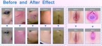 China Stationary Fractional Laser Co2 Machine Scar Removal Infrared Skin for sale
