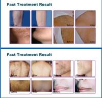 China 808nm Diode Laser Hair Removal Handset Machine With Flaw Less Skin Facial for sale
