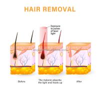 China Rechargeable VCA IPL Hair Removal Machine 808nm Ellipse IPL Machine for sale