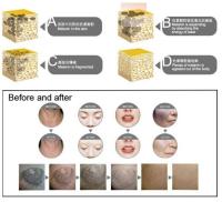China Alexandrite Melasma Picosecond Laser Machine 755nm Tattoo Laser Equipment for sale