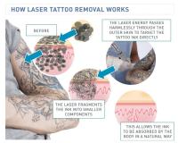 China 500-800ps Pico Laser Tattoo Removal Machine Nd Yag Use For Doctor Toys for sale