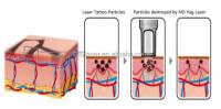 China 100-2000mj Photo Rejuvenation Machine 300w Nd Yag 1064 Laser for sale