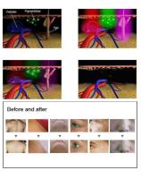 China Q Switched Laser Tattoo Removal Machine for sale