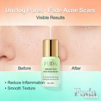 China Salicylic Acid Anti-acne Serum 2% Targeted Acne Removal Mark Fading Gentle Barrier Repair for sale