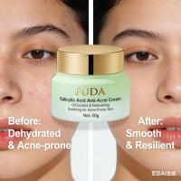 China Salicylic Acid Acne Treatment Cream 50g Moisture Locking Repair Long Term Anti Acne for sale