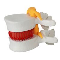 China 3D Vertebrae Cervical Spine Model 1.5X Lumbar Vertebral Spine Herniation for sale