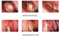 China Low Temperature RF Plasma System Cutting Perforation Ablation Cryosurgery Unit for sale