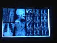 China Low Fog Medical Dry Imaging Film For AGFA5300 / Fuji3000 14 x 17inch for sale