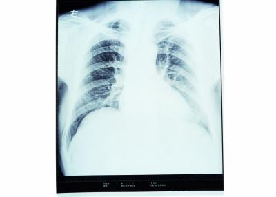 China Medical Dry Imaging Film X-ray For AGFA 5300 / 5302 / 5500 KND-A for sale